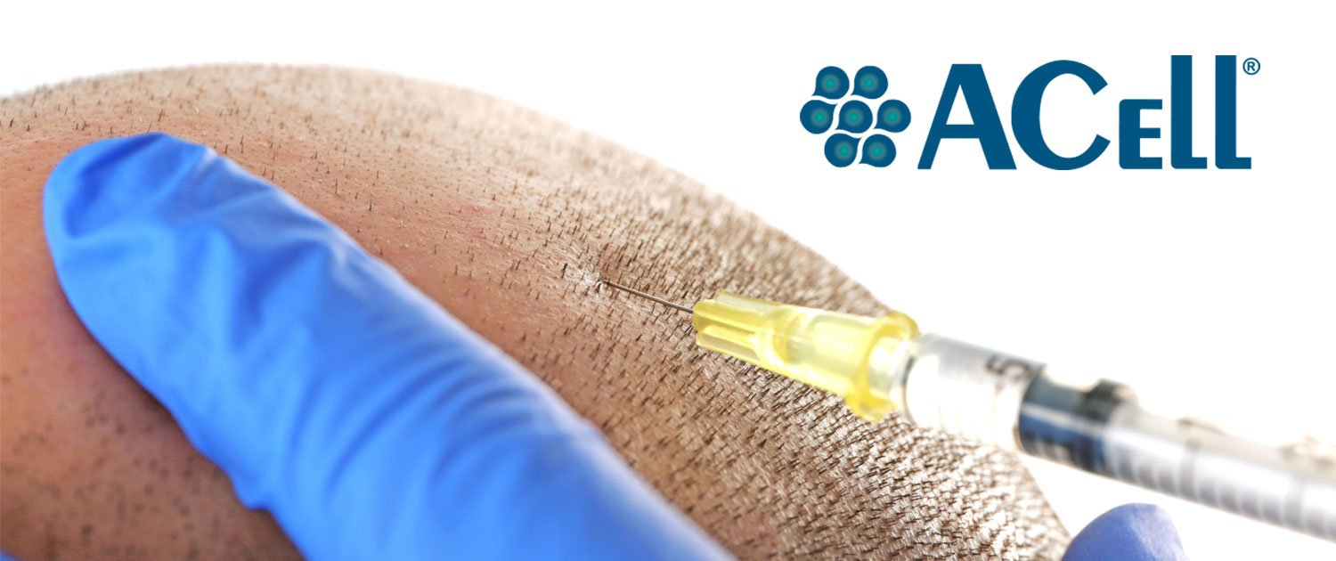 Acell Prp In Hair Transplant Surgery Kansas City Darling Hair