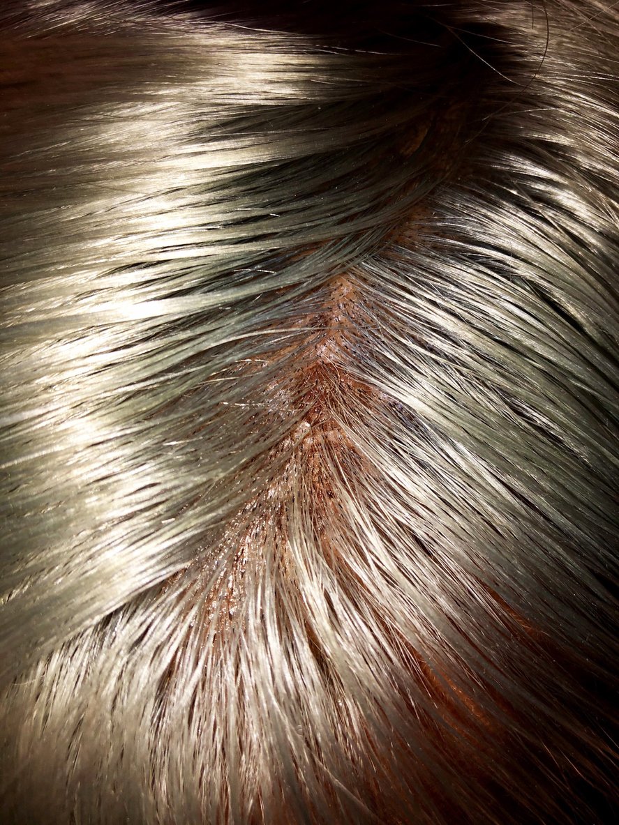 How Scalp Scars Are Repaired | Darling Hair Restoration